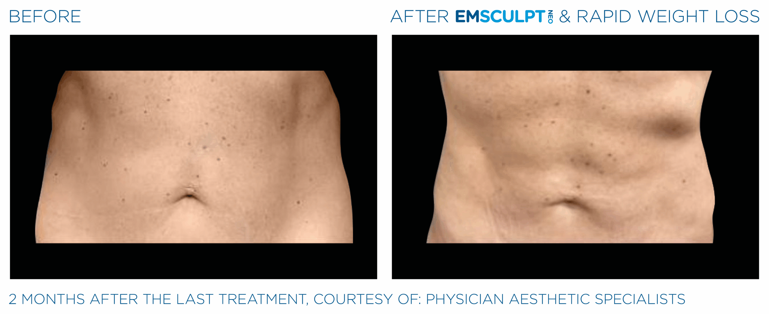 Emsculpt NEO | Burn Fat & Build Muscle - Jonesboro Laser Aesthetics