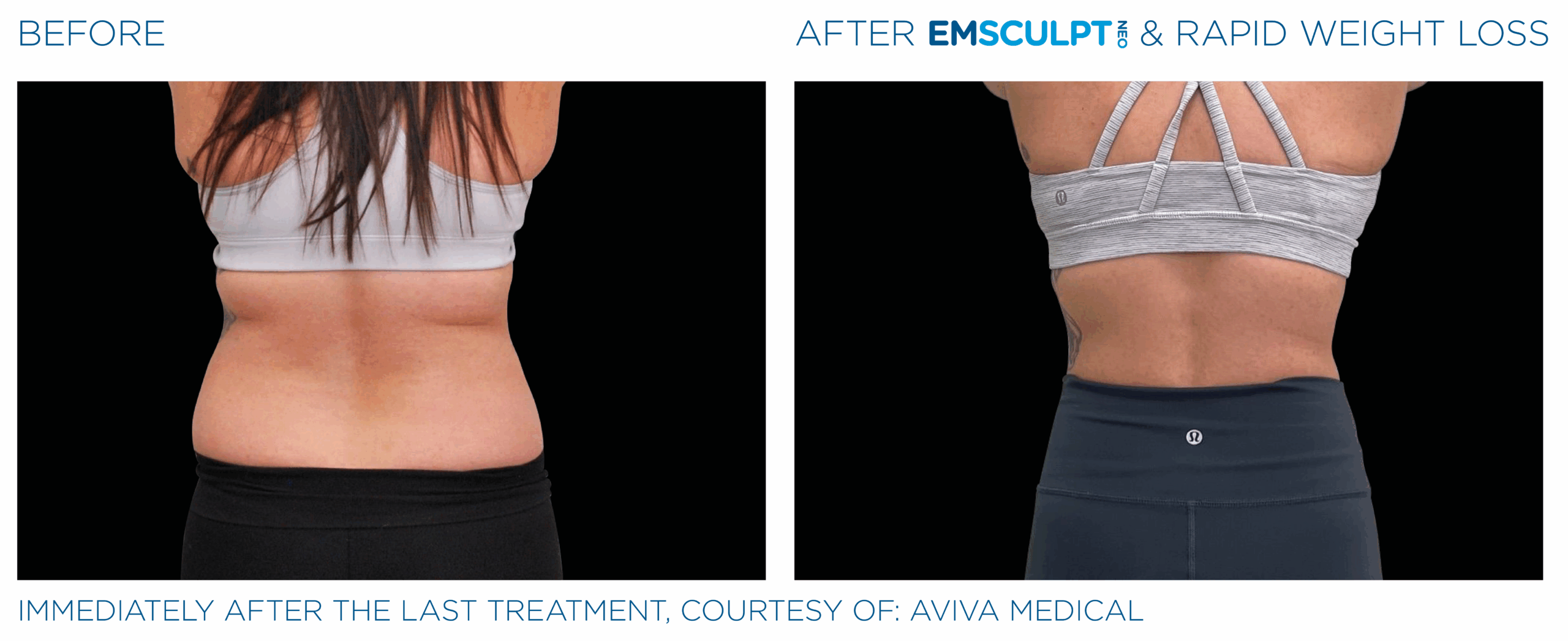 Emsculpt NEO | Burn Fat & Build Muscle - Jonesboro Laser Aesthetics